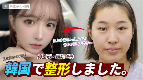 【日本人】三上ゆあさんのようにきれいになりたくて韓国で整形しました。💖 鼻整形 輪郭整形 脂肪移植 💖 韓国jayjun整形外科