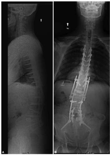Vertebral Column Resection Musculoskeletal Key