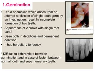 Developmental Disturbances Shape Size And Number Of The Teeth Pptx
