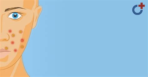 Акнеформные дерматозы от этиопатогенеза до профилактики Портал