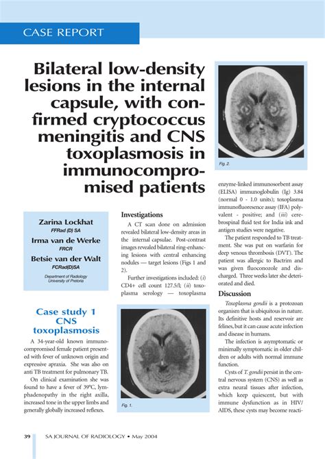 Pdf Bilateral Low Density Lesions In The Internal Capsule With Confirmed Cryptococcus