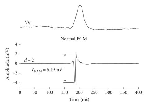 examples of a normal electrogram egm bipolar voltage measurement by