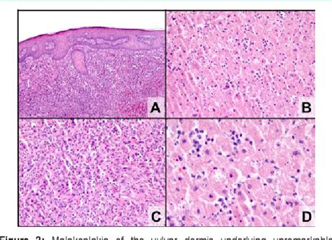 Figure 1 From Malakoplakia Of The Vulva Following Lung Transplantation Semantic Scholar