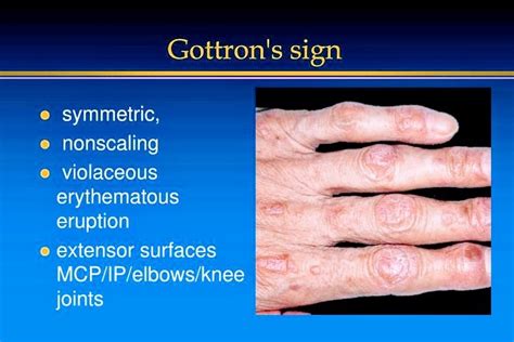 Symptoms Of Dermatomyositis Pt Master Guide