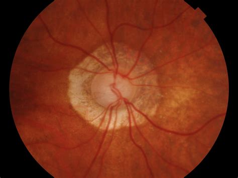 Eye Instance Segmentation Dataset By Eye