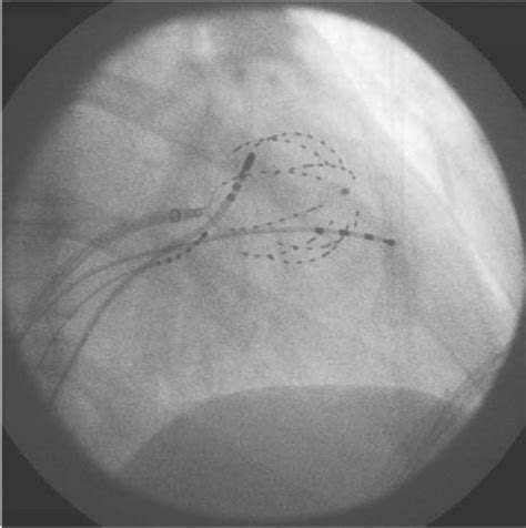 Case 2 Bi Plane X Ray Views Showing Three Electrical Measurement Download Scientific Diagram