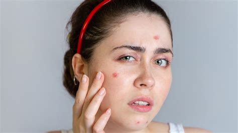 Tác Dụng Phụ Của Isotretinoin Và Cách Hạn Chế Tối đa