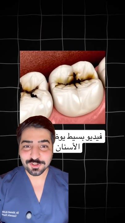 تسوسات الأسنان 🦷🙊 طفلي الشعبالصينيمالهحل ترند Dentalsecrets