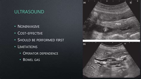Acute Cholangitis PPTX
