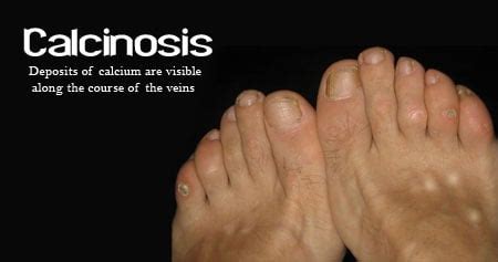 Calcinosis