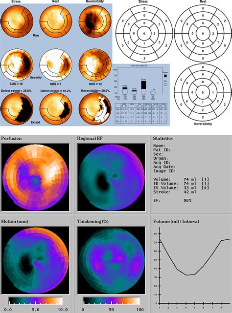ai‐augmented radiomic feature extraction for myocardial perfusion top