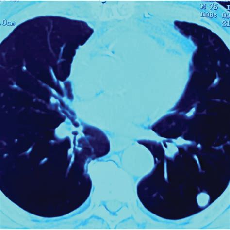 Ct Scan Of Case N°1 Large Mass Of The Left Apical Lung 80×50 Mm With
