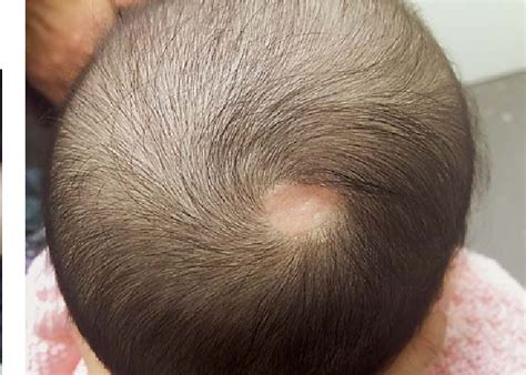 A Ap Cutis Aplasia