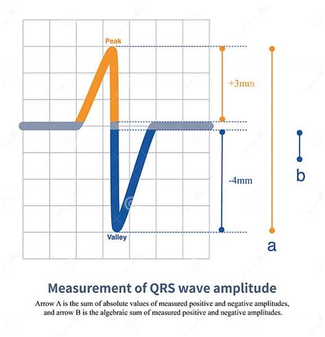 Measurement Of Qrs Wave Amplitude Stock Illustration Illustration Of