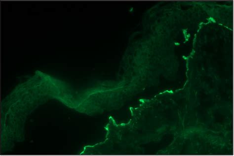 Accuracy Of Serration Pattern Analysis By Direct Immunofluorescence In
