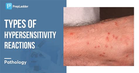 Medical Mnemonics Types Of Hypersensitivity Reactions Hypersensitivity