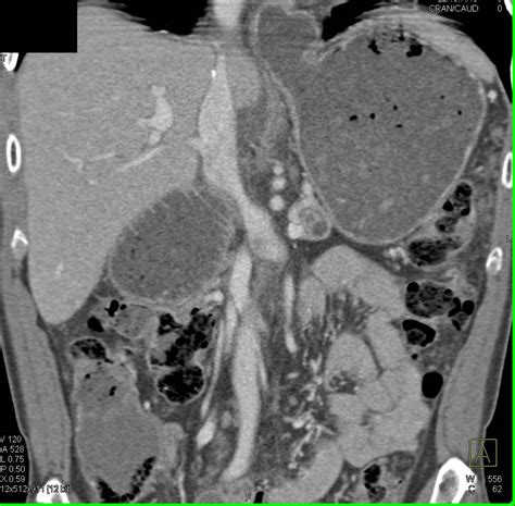 Obstruction Of The Gastrojejunostomy Loop Small Bowel Case Studies