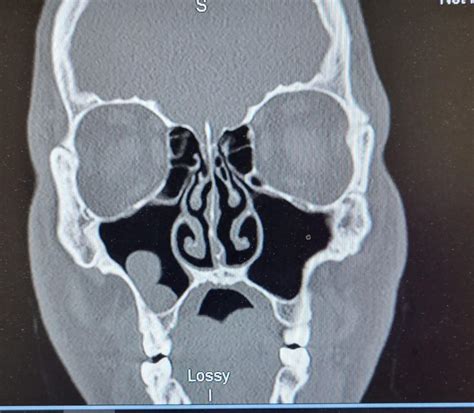 Here Is The Best Photo Of My Ct Scan What Do You Think R Sinusitis