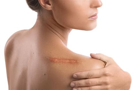 Premium Photo Woman With A Scar On Her Shoulder Over White Background