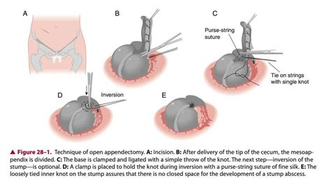 Appendectomy By Mohan Krishna Redlapalle презентация онлайн