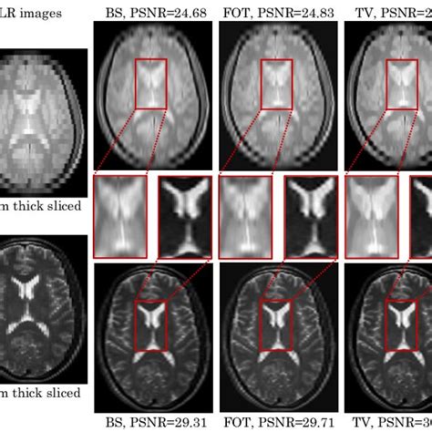 PDF MRI Super Resolution Using Multi Channel Total Variation