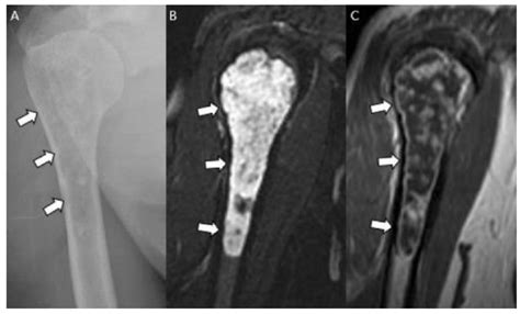 A Typical Cartilaginous Tumor Of The Humerus In A 43 Year Old Woman