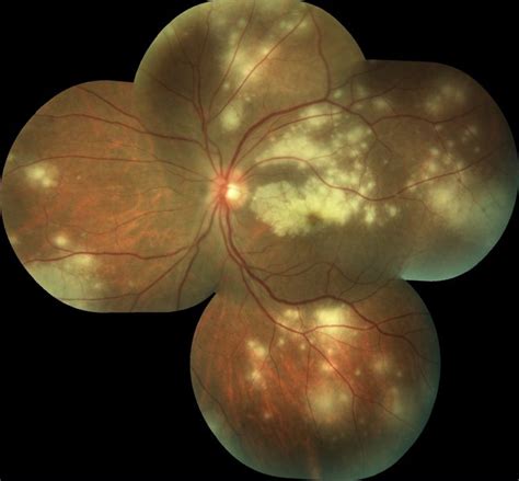 Progressive Outer Retinal Necrosis Diego Desio