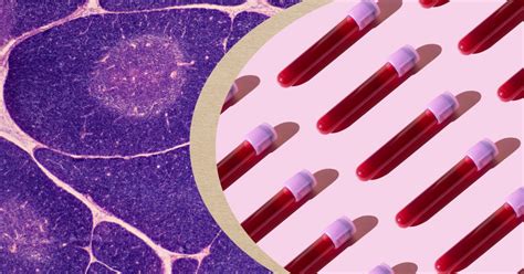 Leucémie Les Signes Qui Doivent Alerter Marie Claire