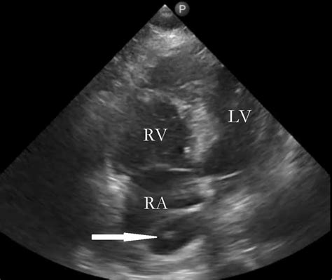 Still Image Of Video 3 Right Ventricle Focused Apical 4 Chamber View