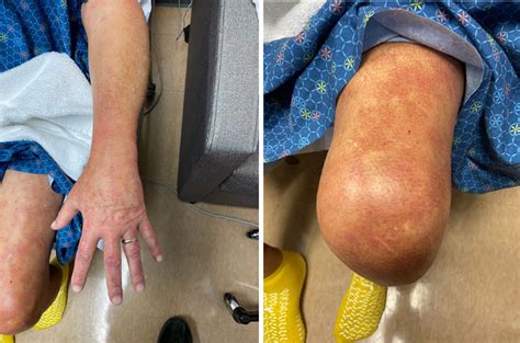 Sclerodermatous Eruption In A Patient With Metastatic Colon Cancer Treated With An Flt3cdk