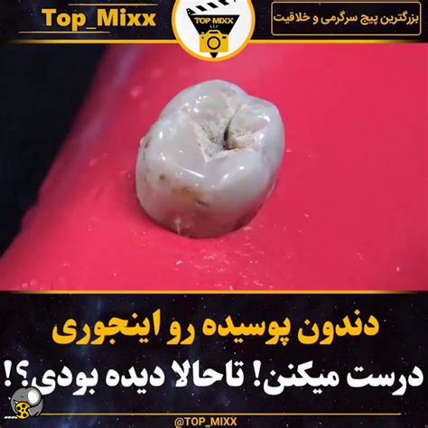 ببینید چجوری دندون پوسیده رو درست میکنه فیلو