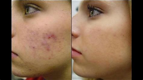 علاج حب الشباب والتخلص من ندباته بأرخص وأسهل طريقة لجميع أنواع حب