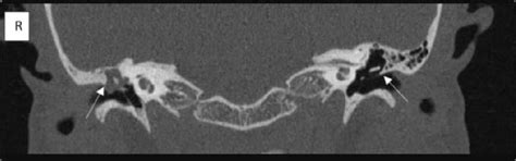Scutum Temporal Bone