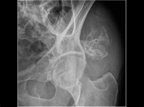 Musculoskeletal Bone Muscle Nerves And Other Soft Tissues 7 1 Bone Case 7 1 2 Exostosis