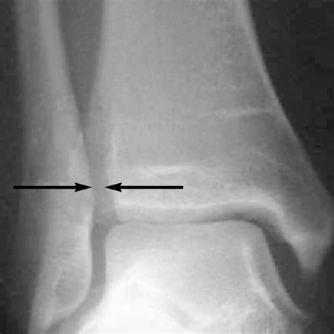 Radiograph Showing Widening Of The Tibiofibular Clear Space Arrows Download Scientific