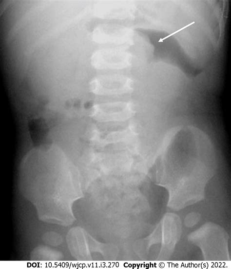 Meniscus Sign Intussusception