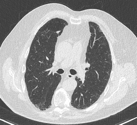 Axial Ct Image Showing Medium Sized Solid Nodule In The Anterior Download Scientific Diagram