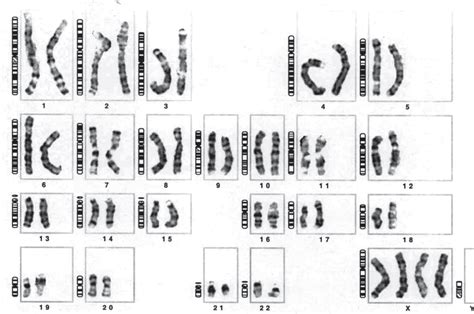 Figure 3 From 48 Xxxx A Rare Aneuploidy Semantic Scholar