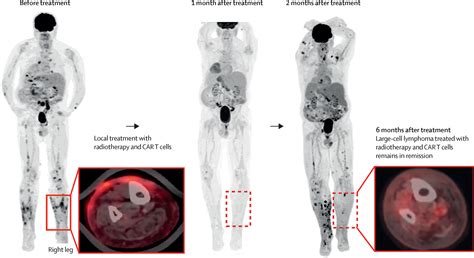 Enhancing Car T Cell Therapy Through Cellular Imaging And Radiotherapy