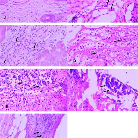 Infiltration Of Neutrophil Pmn In The Skin Wound Area Download