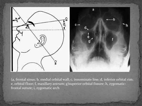 Radiography And Anatomy Of Orbit Pptx