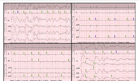Figure 7 From Six Lead Electrocardiography Compared To Single Lead Electrocardiography And