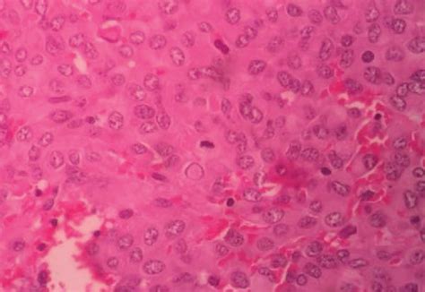 Microscopic Appearance Of The Ileal Malignant Gist Stained With Download Scientific Diagram Microscopic Appearance Of The Ileal Malignant Gist Stained With Download Scientific Diagram