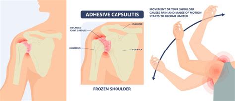 Frome Physical Therapy Rolfing Cst Acupuncture
