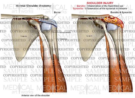 Shoulder Synovitis Bursitis Normal — Medical Art Works