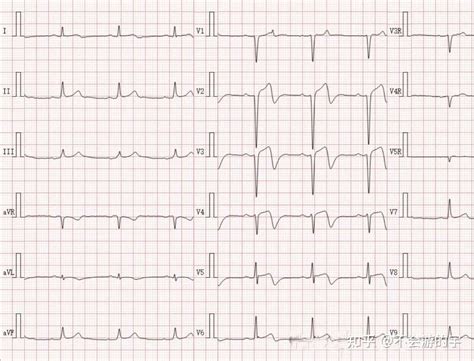 急性心肌梗死的分型和分期 知乎