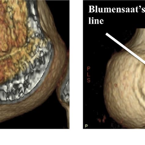 High Noon Femoral Bone Tunnel A When The Centre Of The Femoral Bone Download Scientific