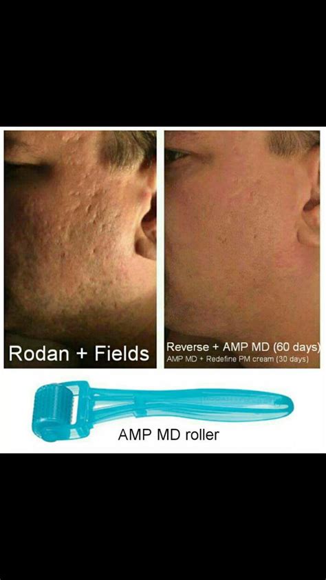 Pin On R F Amp Md Roller And Macroexfoliator