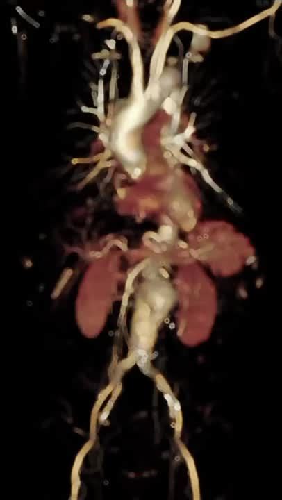 Successful Laser Fenestrated Evar Procedure An 80 Year Old Patient