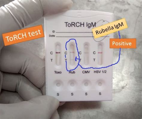 TORCH Test Positive Introduction Principle Test Procedure Result Interp